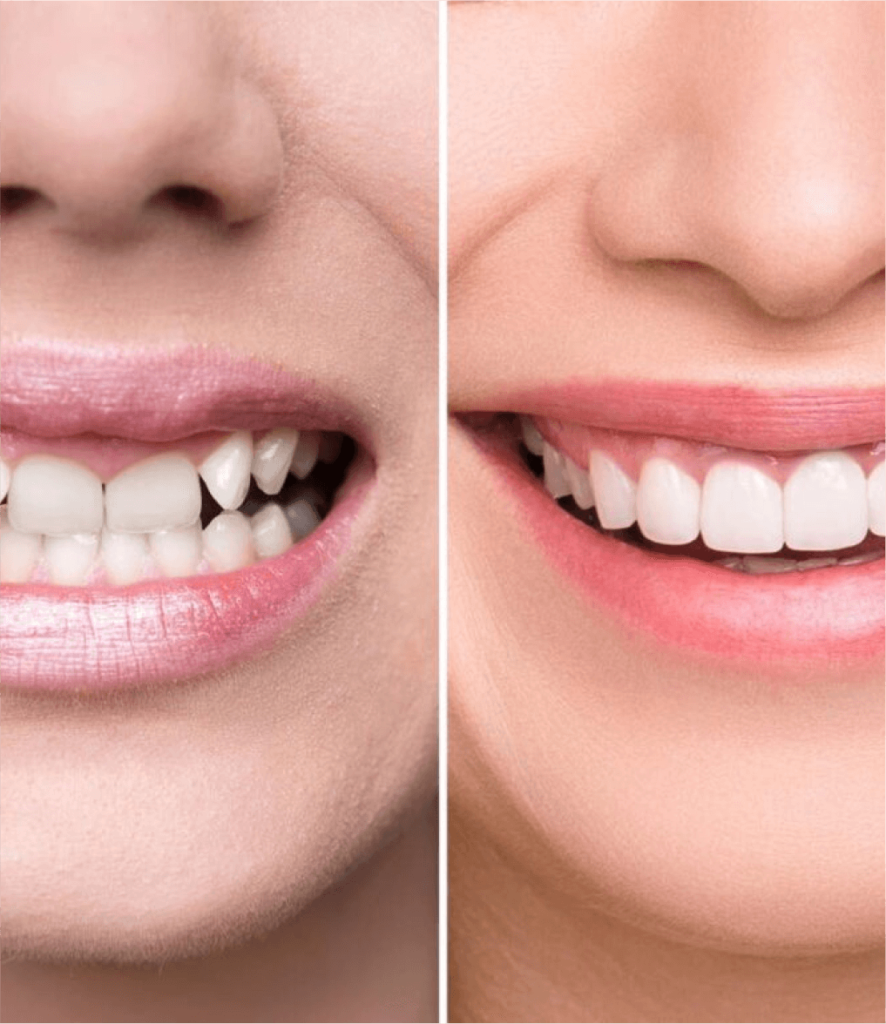 Smile Design – Radiant Dental Clinic